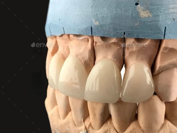 Mouth model with porcelain teeth. Press ceramic crowns and veneers a 1 ...