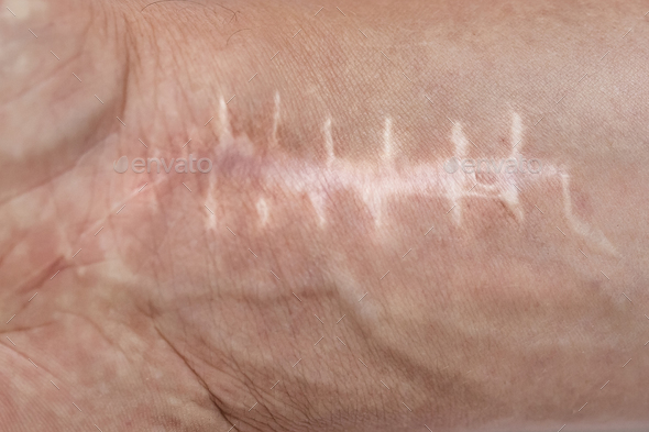 Scar with stitches on the wrist after surgery. Fracture of the bones of ...