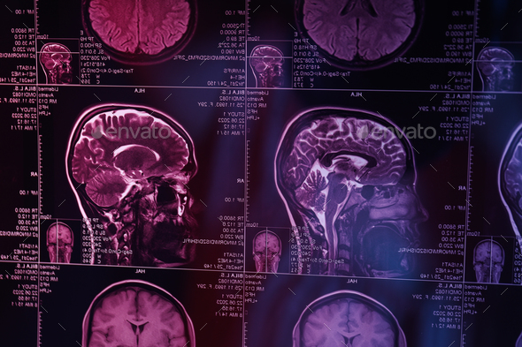 MRI or magnetic resonance imaging of the head and brain. Close up Stock ...