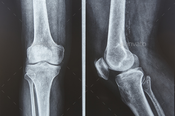 Knee xray. Knee xray. Front and lateral view. Healthcare. Examination ...