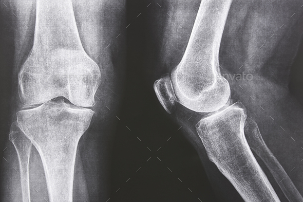 Knee xray. Knee xray. Front and lateral view. Healthcare. Examination ...