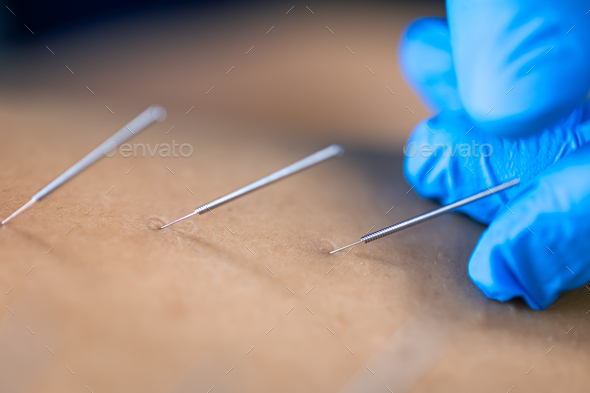 Close up of a needle and hands of physiotherapist doing a dry needling ...