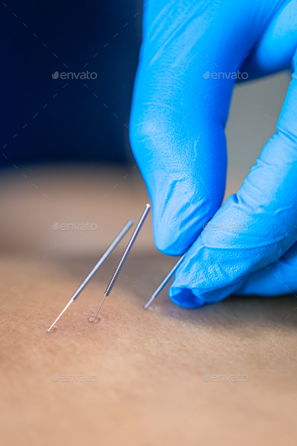 Close up of a needle and hands of physiotherapist doing a dry needling ...