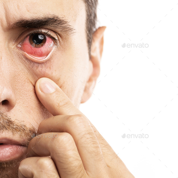 Man with the Subconjunctival hemorrhage in his eye Stock Photo by BLACKDAY