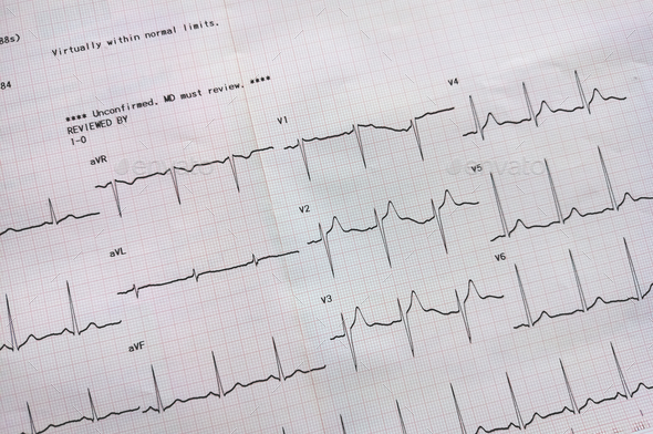 Graph showing the results of the electrocardiogram (EKG) report on ...