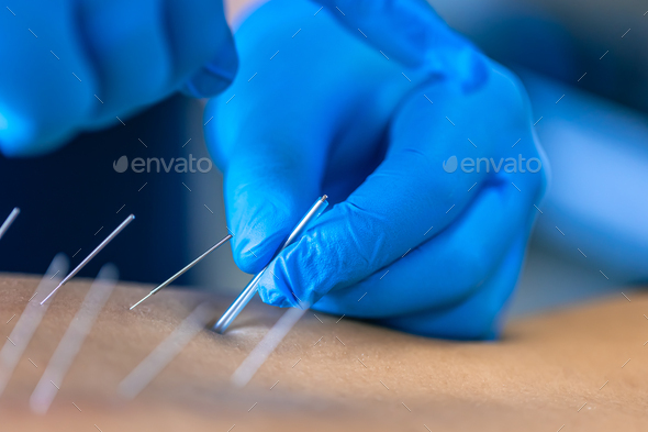 Close up of a needle and hands of physiotherapist doing a dry needling ...