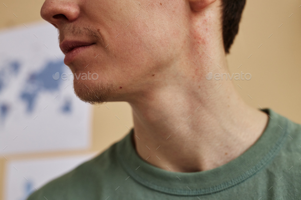 Man with skin rash or psoriasis spots on neck Stock Photo by ...