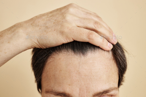 Receding hairline close up Stock Photo by seventyfourimages | PhotoDune