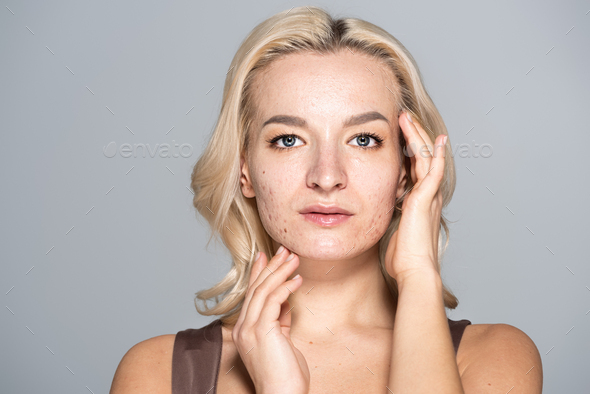 Portrait of blonde model with skin issue touching face isolated on grey ...