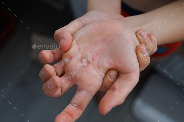 Torn skin on the palm of my hand from a hard workout, A lacerated ...