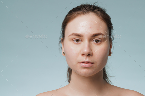 portrait of a girl with problem skin before procedures, facial skin ...