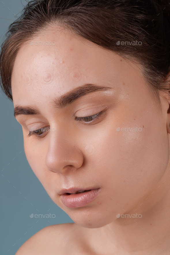 Girl with acne stick round acne patch on her cheek.Facial rejuvenation ...