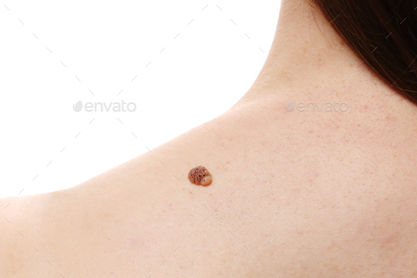 large nevus wart on young female shoulder, woman visiting doctor ...