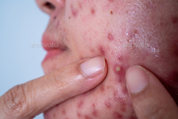 Acne on face because the disorders of sebaceous glands productions ...