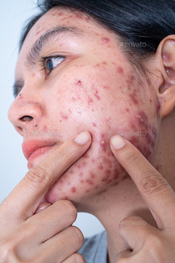 Acne on face because the disorders of sebaceous glands productions ...