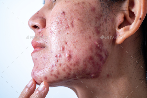 Acne on face because the disorders of sebaceous glands productions ...
