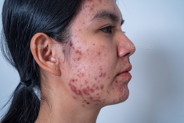 Acne on face because the disorders of sebaceous glands productions ...