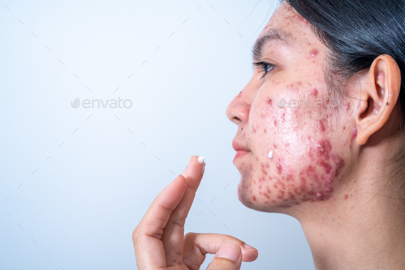 Acne on face because the disorders of sebaceous glands productions ...
