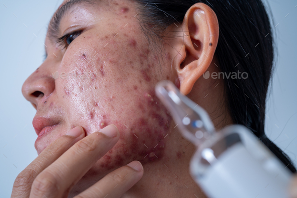 Acne on face because the disorders of sebaceous glands productions. Acne or a Cosmetic Stock ...