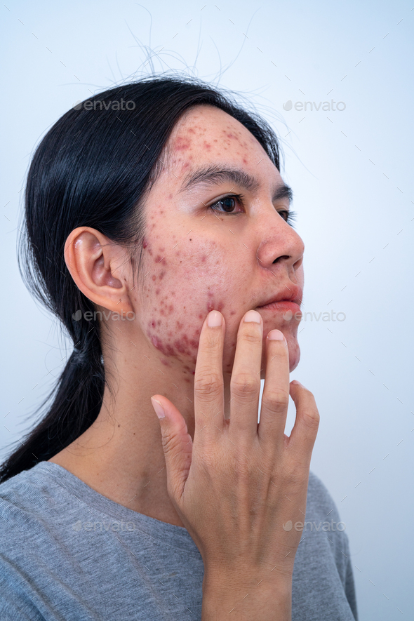 Acne on face because the disorders of sebaceous glands productions ...