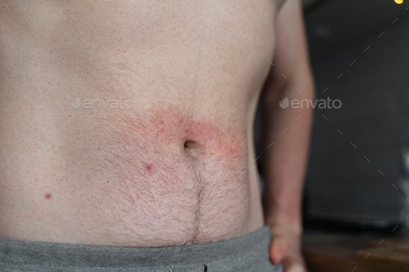Close-up of man's body belly at home in kitchen with dermatitis rush ...