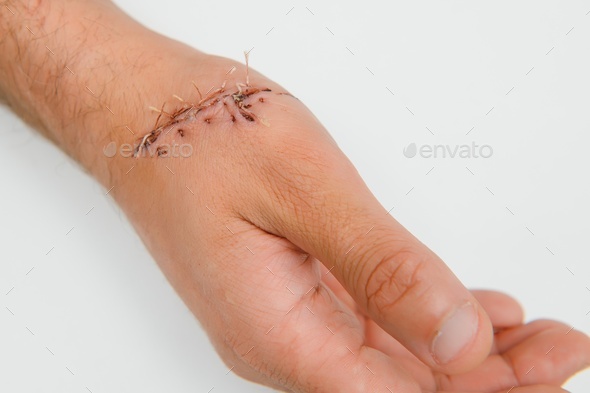 Suture wound on hand,Pain of accident concept Stock Photo by sedrik2007