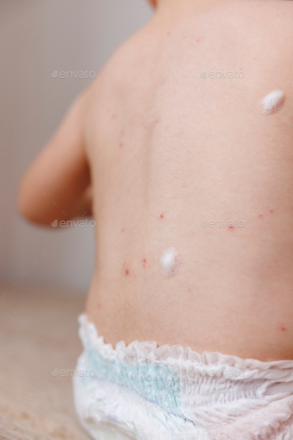 Detail of baby's skin covered with Varicella blisters Stock Photo by ...