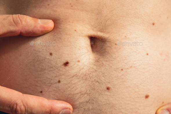 Male hand showing birthmarks on skin body stomach part. Close up detail ...