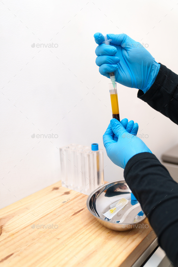 Nurse Preparing PRP Using Centrifuge in Hair Loss Treatment Stock Photo ...
