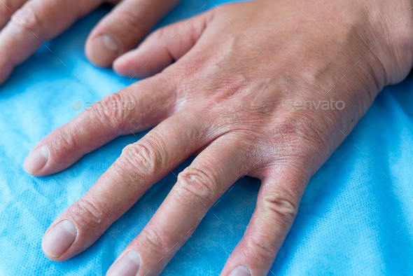 Treatment of dermatitis and psoriasis. Close-up of hands with very poor ...