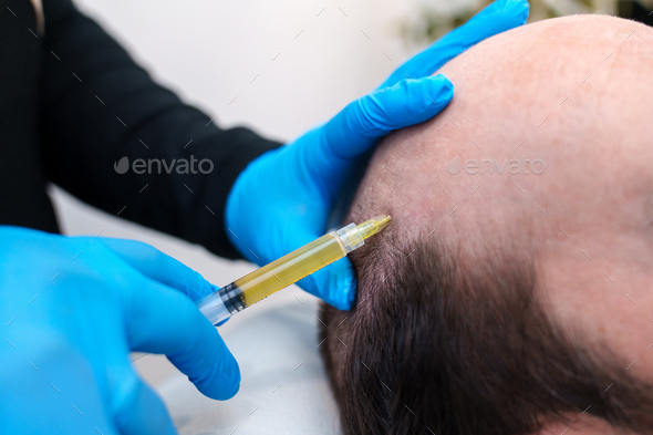 Precision PRP Injection Technique for Scalp Hair Regrowth Therapy Stock ...