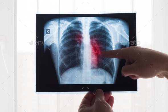 Lung radiography concept. Radiology doctor examining at chest x ray ...