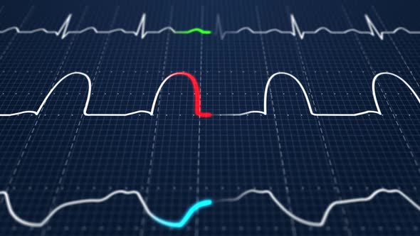 Animation of Intensive Care Unit monitor showing normal values for ...