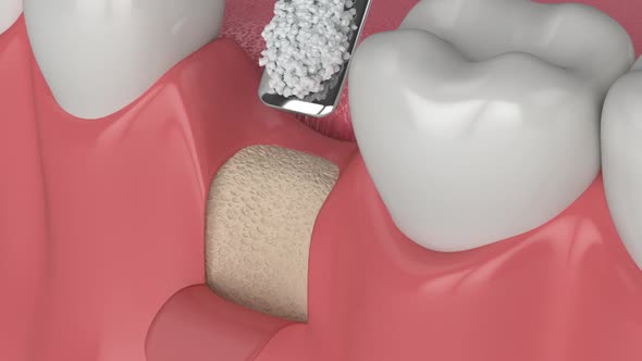 3d dental bone grafting and bone augmentation procedure, Motion Graphics