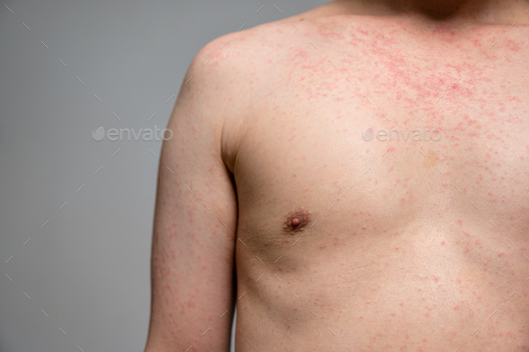 Dermatitis rash viral disease with immunodeficiency on body of young ...