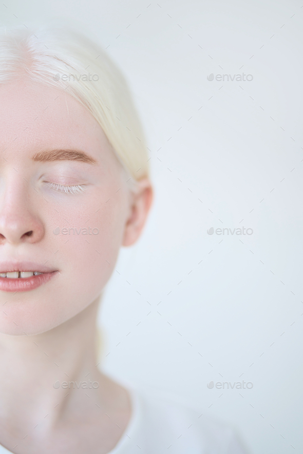 Beautiful inclusive albino teen girl on white background. Half face ...