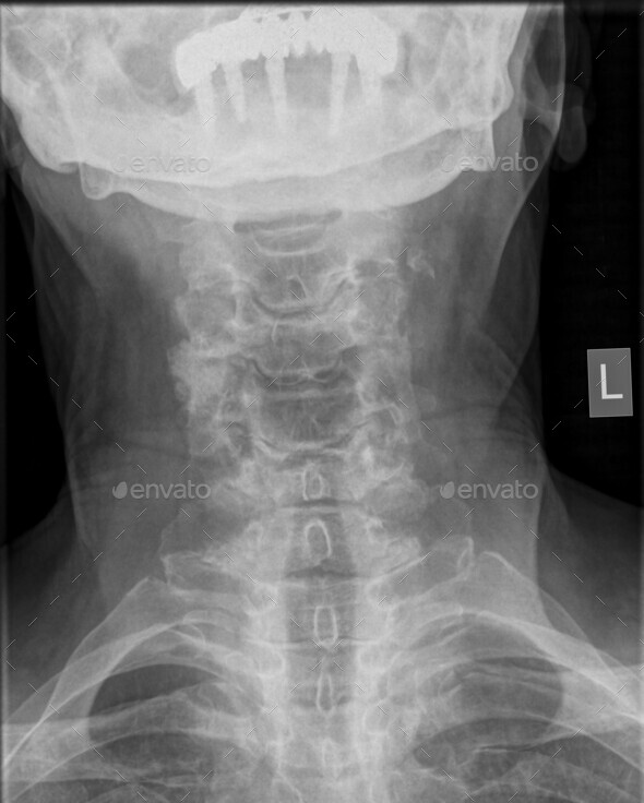 Xray image showing a cervical spine fusion surgery with implants Stock ...