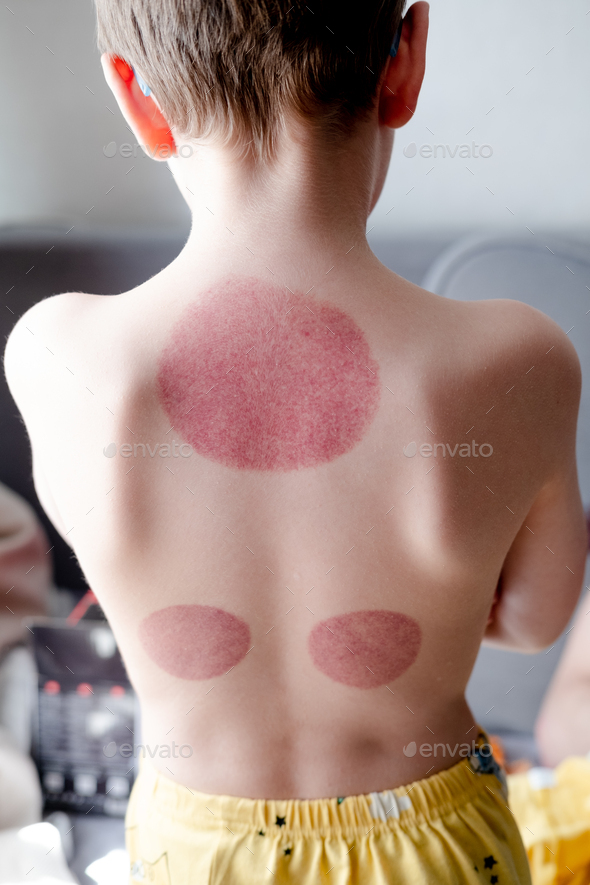 Red spots on the back of a little boy after cupping procedures, rear ...