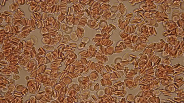 Blood Under a Microscope, Adhering Red Blood Cells in Clotted Blood ...