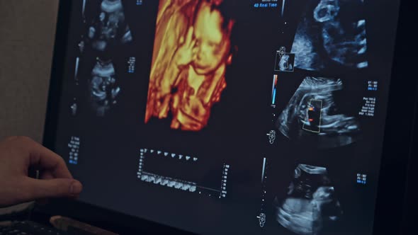 Ultrasound Monitor Screen Show Baby in Mother's Womb, Stock Footage