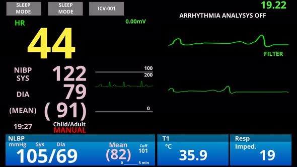 Patient Returns From Medical Death, Pulse Down Then Up, ER Vital Signs ...
