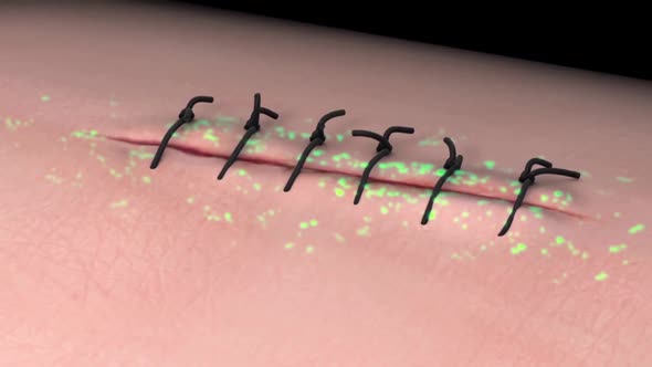 Animation of infected wound, Motion Graphics | VideoHive