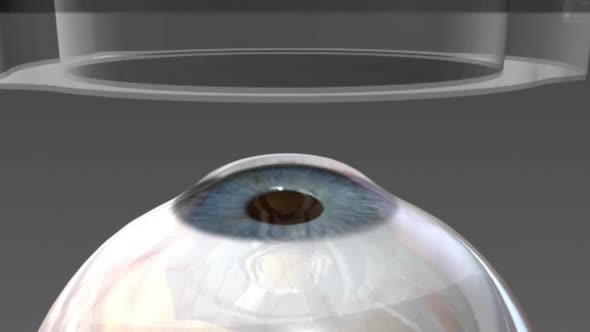 Anatomy of the eye. laser eye surgery, Motion Graphics | VideoHive