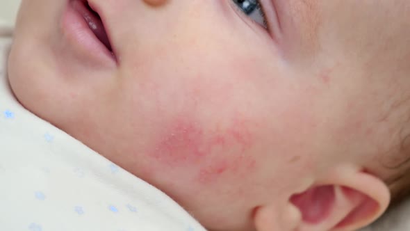 Closeup of Baby Face Skin with Pimples and Acne From Dermatitis, Stock ...