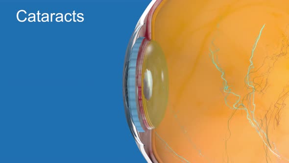 3D Medical Animated eye anatomy cataract on blue background, Motion ...