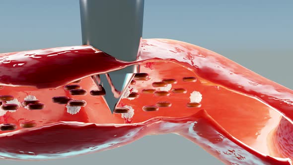 Hemostasis. Basic steps of wound healing process. animation. cross ...