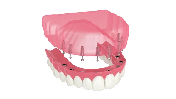 Removable snap-on full implant denture installation, Motion Graphics