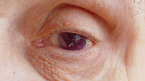 Eye with Complete Loss of Vision Closeup, Stock Footage | VideoHive