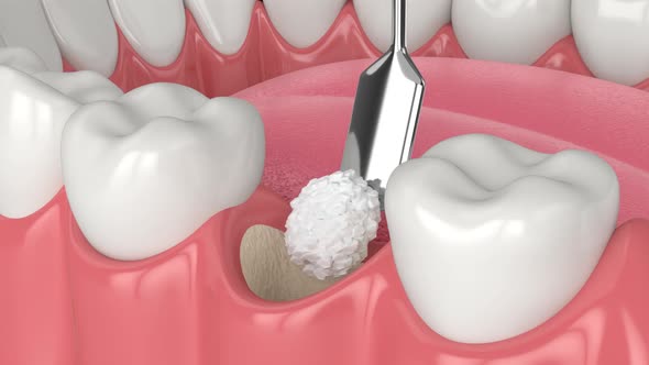 dental bone grafting and bone augmentation procedure, Motion Graphics