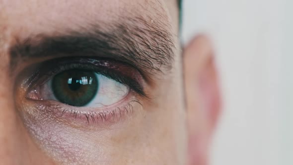 Real Black Eye on the Young Male Face Bruise on a Man Eyelid, Stock Footage